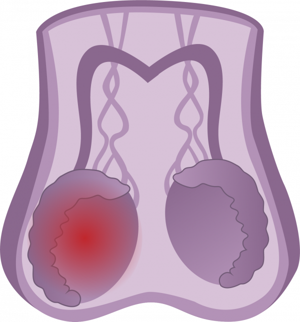 Síntomas y causas del cáncer de testículo - CUAN Hospital - Centro de ...