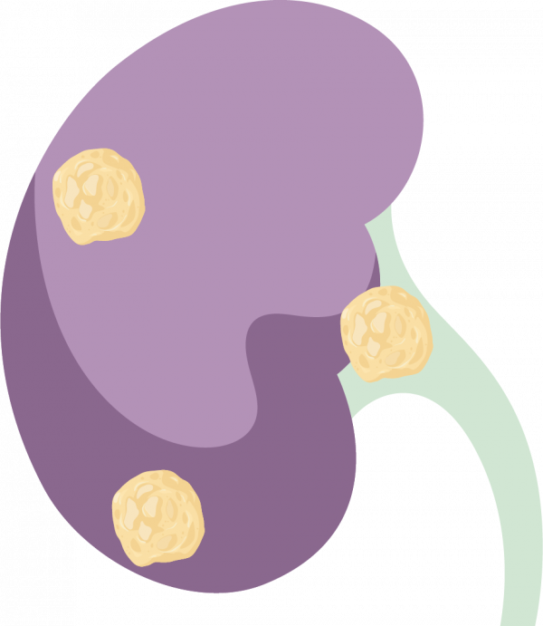 ¿Qué es la Litiasis Urinaria? CUAN Hospital para ti.