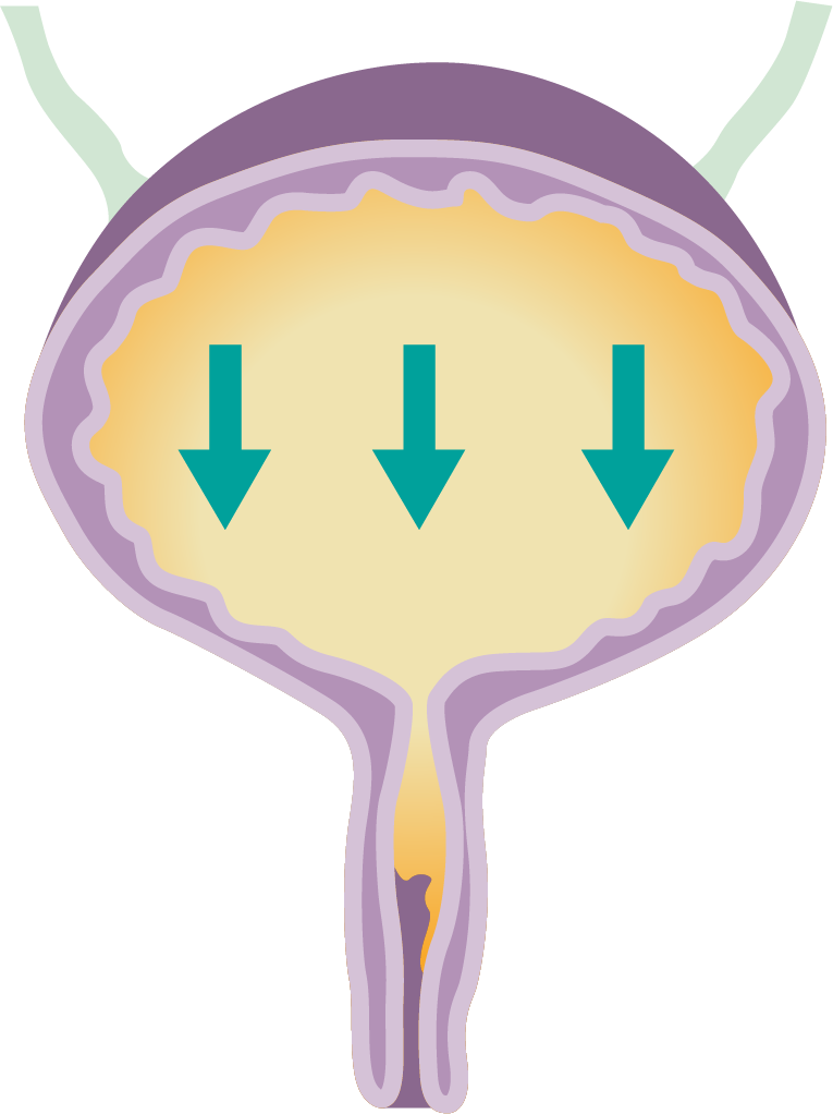 ¿Qué es la nicturia? - CUAN Hospital - Centro de Urología Avanzada del ...