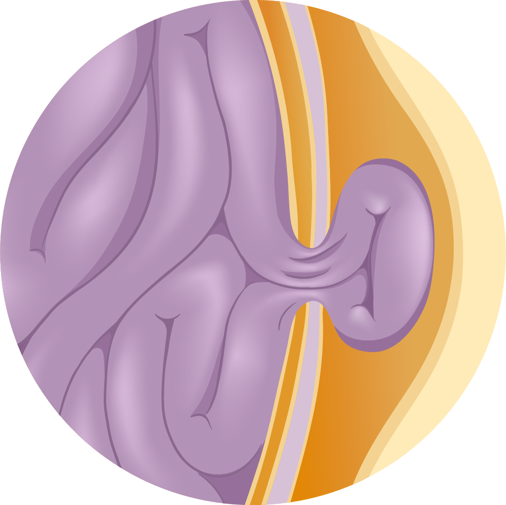 ¿Qué es una hernia inguinal? - CUAN Hospital - Centro de Urología ...